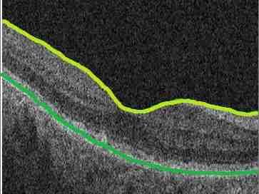 Automatic Measurement of Retinal Thickness from OCT Scans