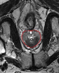 Computer Vision in Prostate Segmentation of MR Images