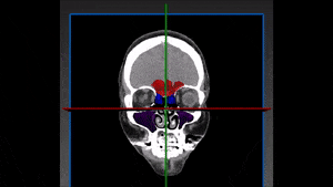 Sinus segmentation with deep learning by RSIP Vision