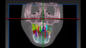 Dental Segmentation Module with Deep Learning by RSIP Vision